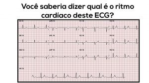 Você saberia dizer qual ritmo cardíaco deste ECG? – CardioSite