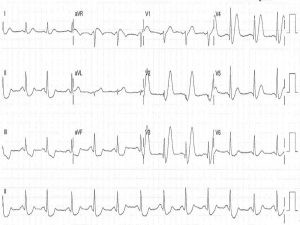 Você sabe o que é o padrão ‘‘De Winter’’ no ECG? – CardioSite